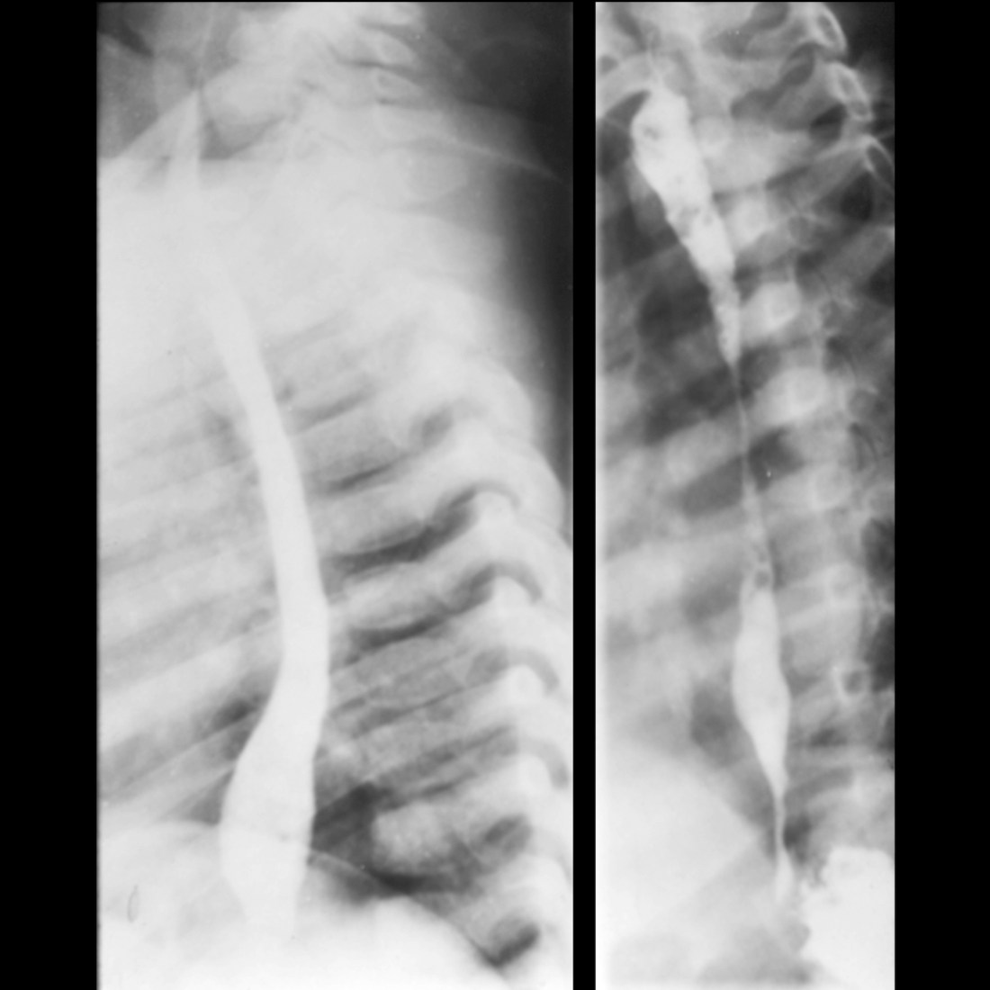 Pediatric Corrosive Esophagitis | Pediatric Radiology Reference Article ...