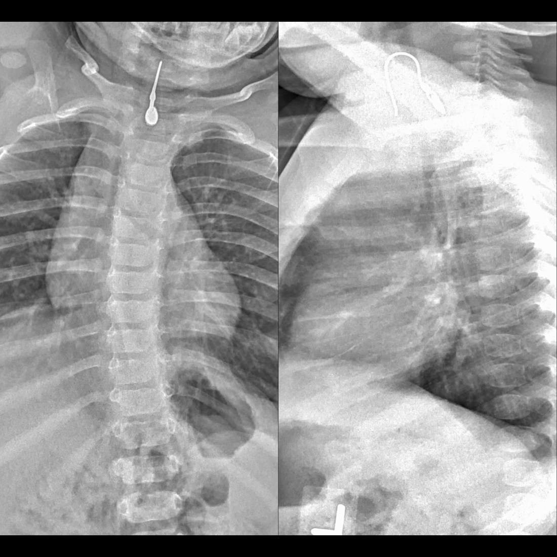 Toddler who was seen to eat something they should not have eaten ...