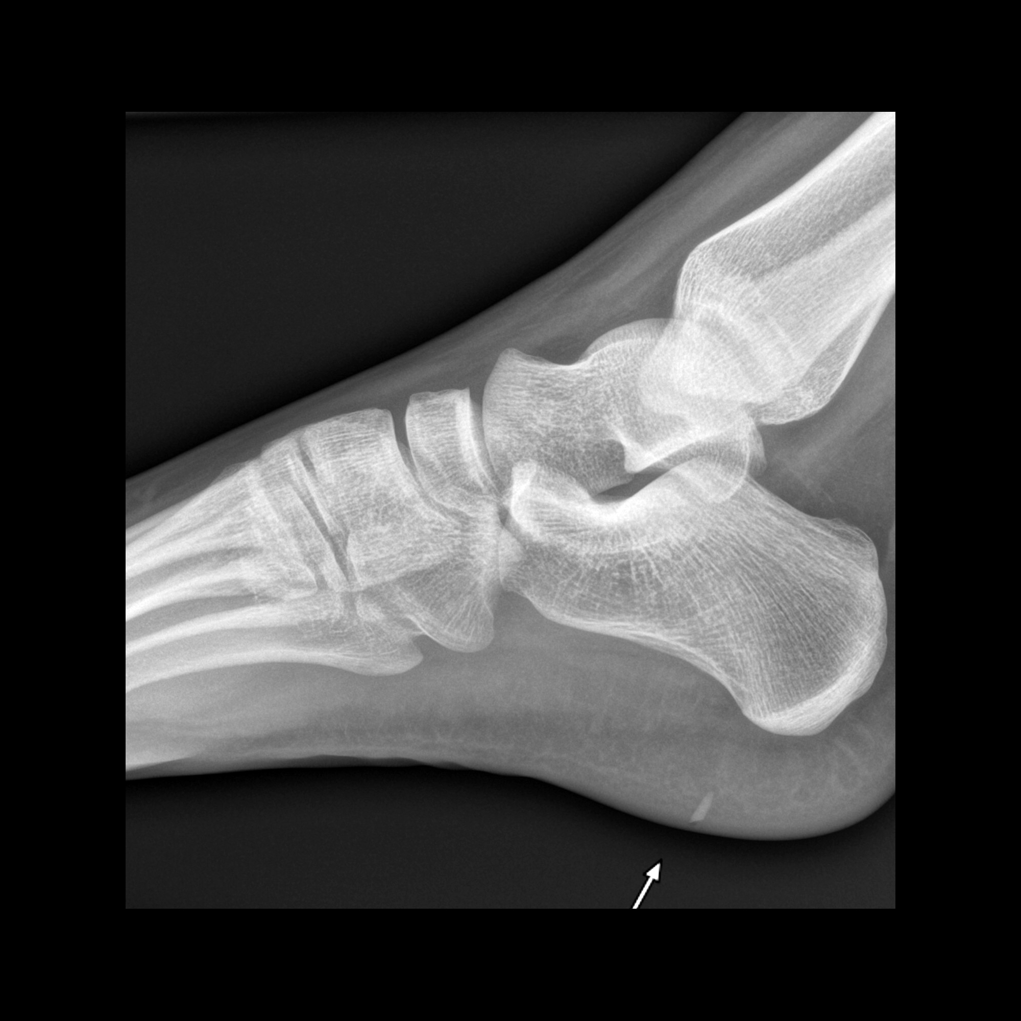 Pediatric Foreign Body in the Soft Tissues | Pediatric Radiology ...