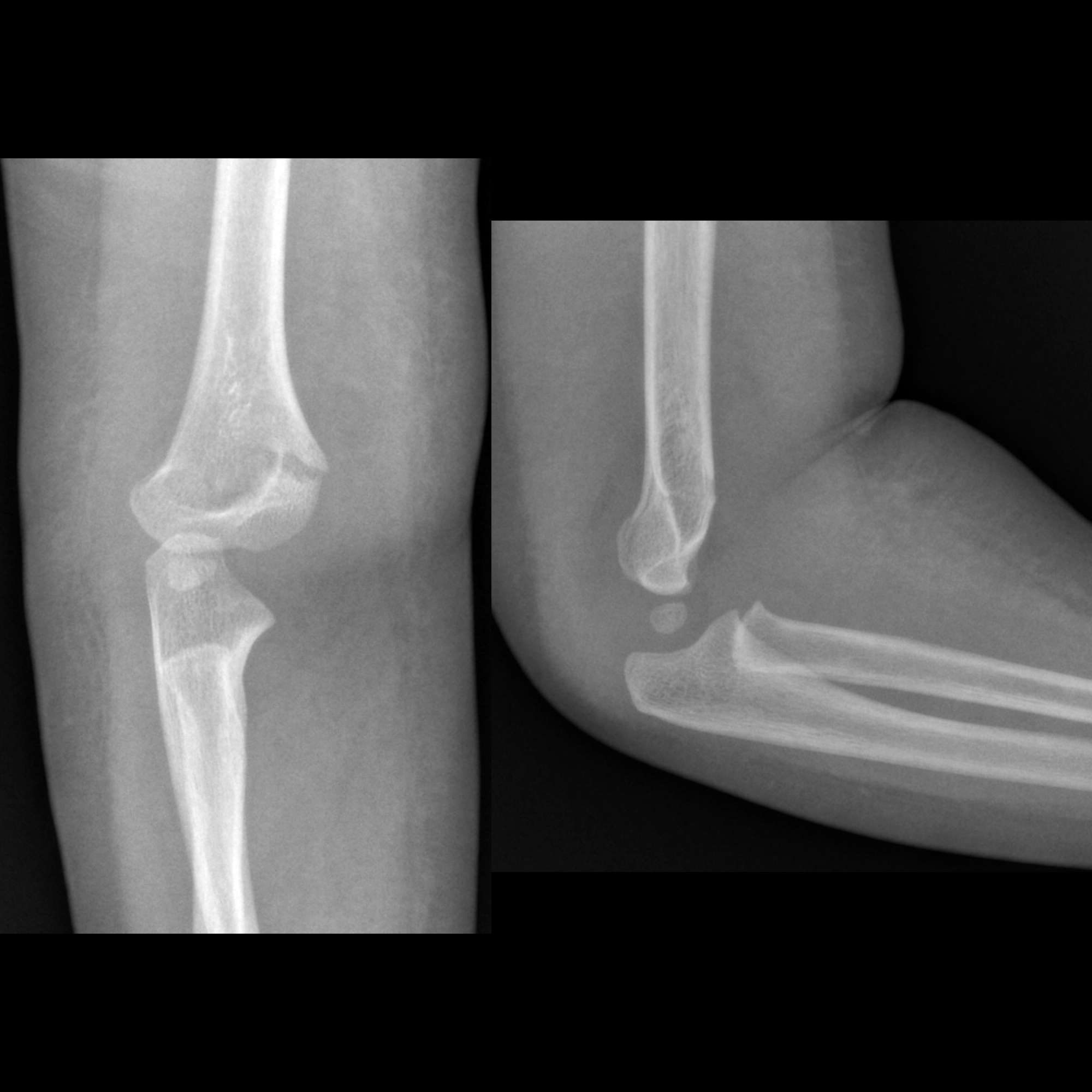 Pediatric Elbow Fracture | Pediatric Radiology Reference Article ...