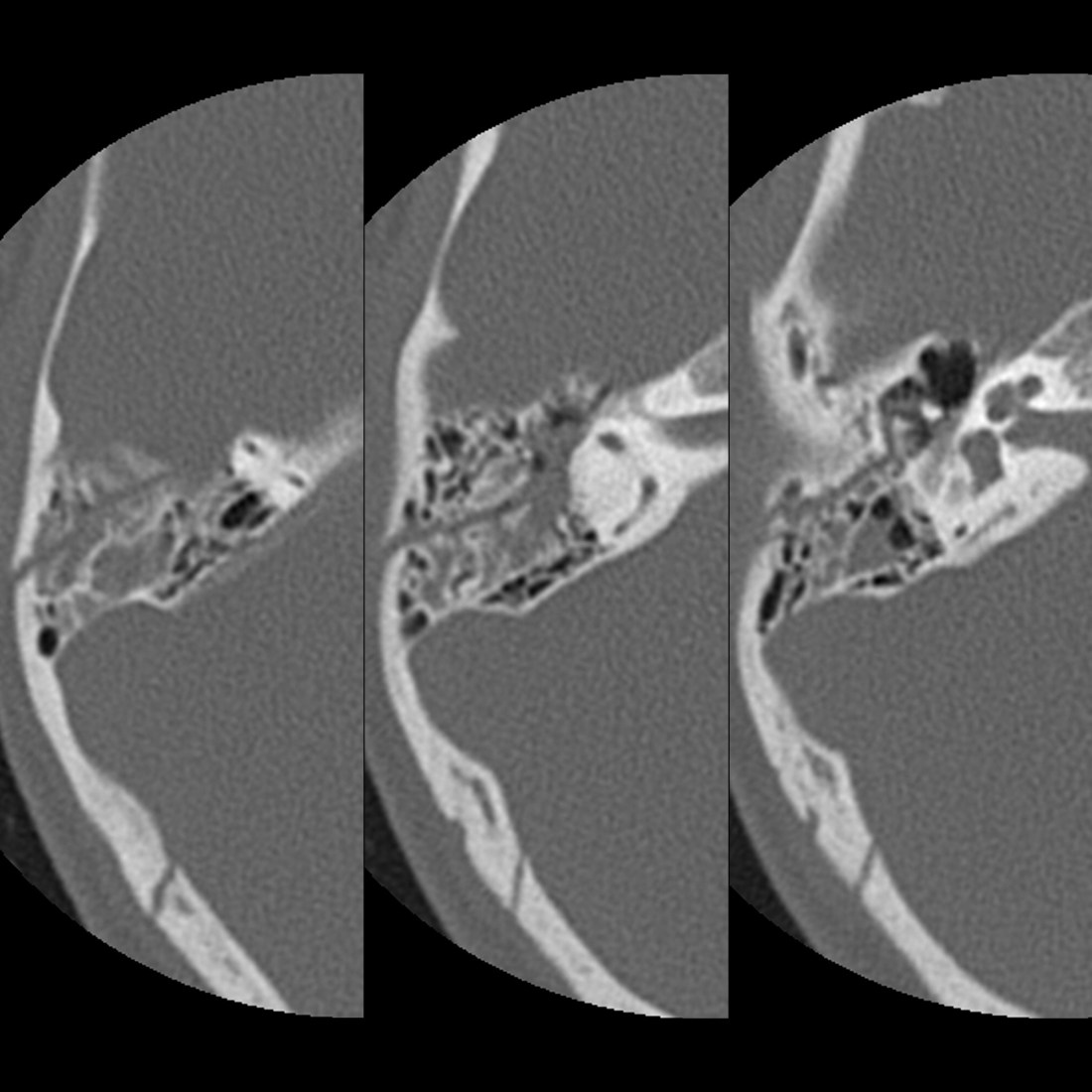 Pediatric Temporal Bone Fracture | Pediatric Radiology Reference ...