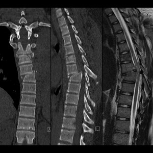 Pediatric Thoracic Spine Fracture | Pediatric Radiology Reference ...