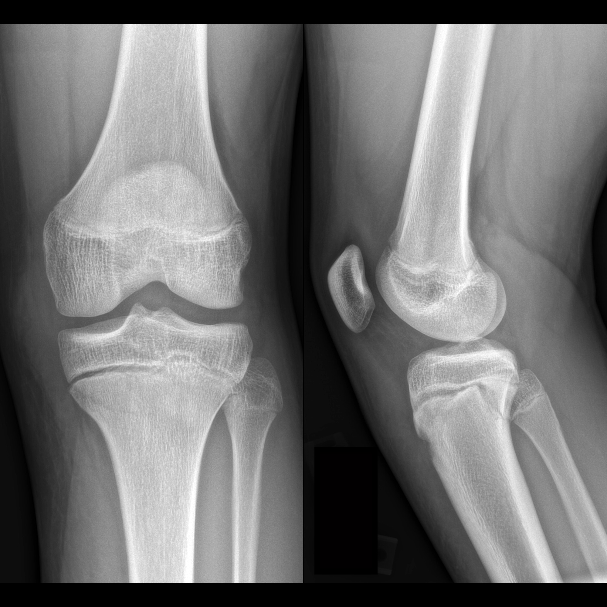 Pediatric Tibial Plateau Fracture | Pediatric Radiology Reference ...