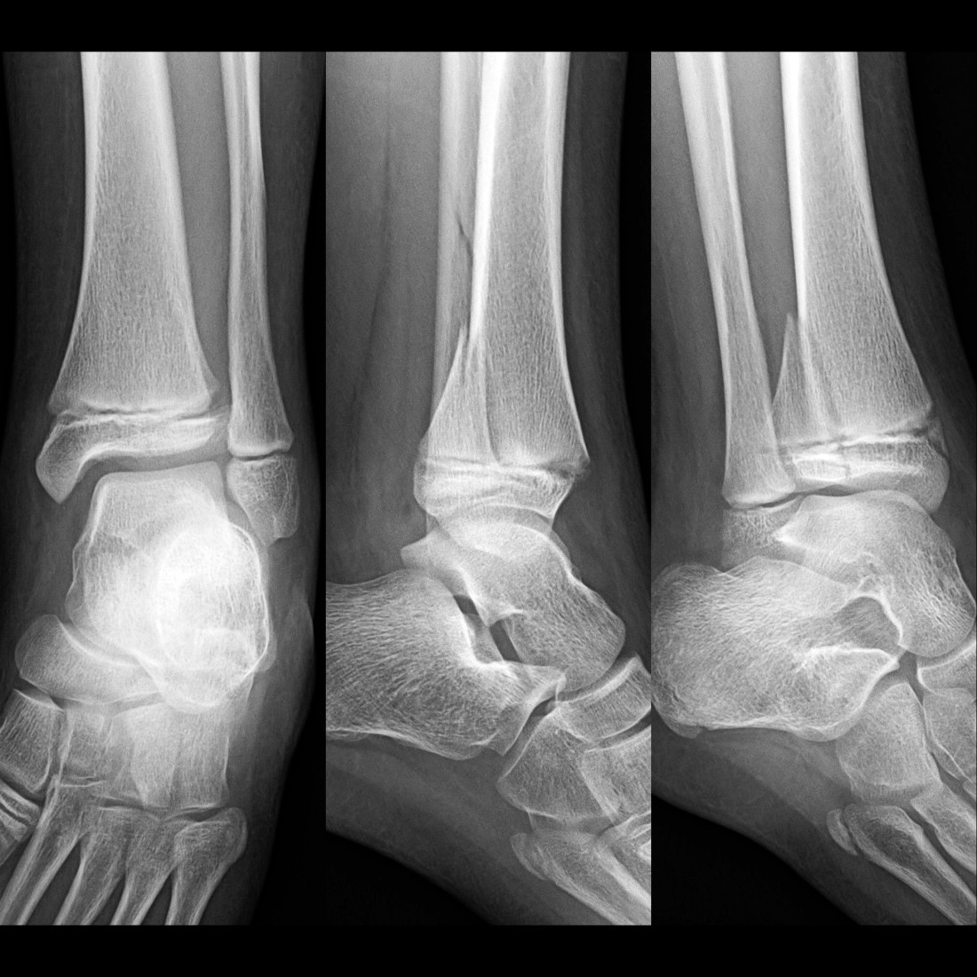 Triplane Fracture | Pediatric Radiology Reference Article | Pediatric ...