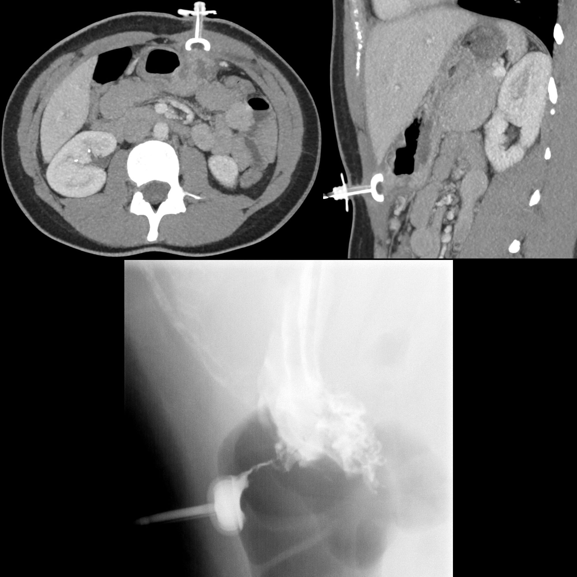 GastrostomyTubeMalfunction15MDGastrostomyTubeTipInSubcutaneousTissueOnC ...