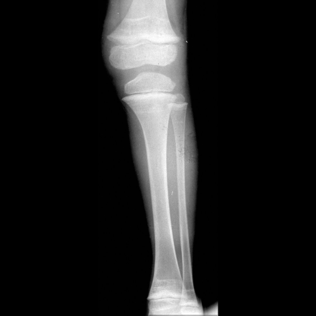 Pediatric Growth Arrest Lines | Pediatric Radiology Reference Article ...