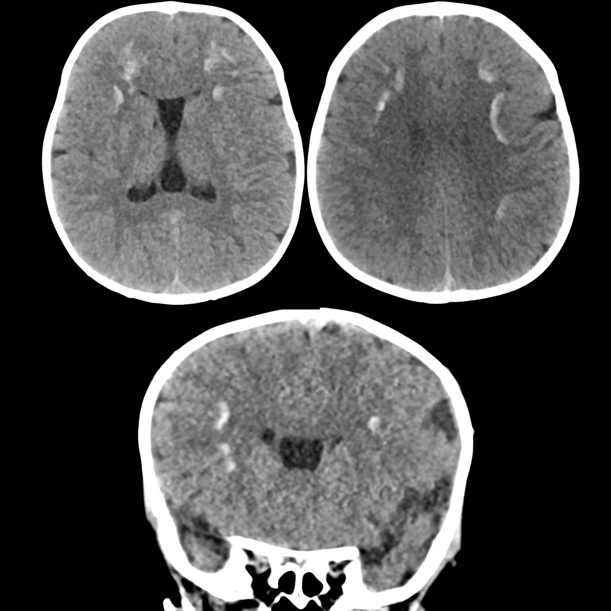 Cavum Septum Pellucidum | Pediatric Radiology Reference Article ...
