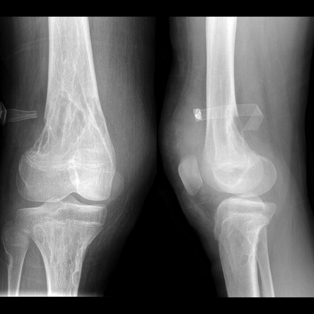 Non Ossifying Fibroma | Pediatric Radiology Reference Article ...