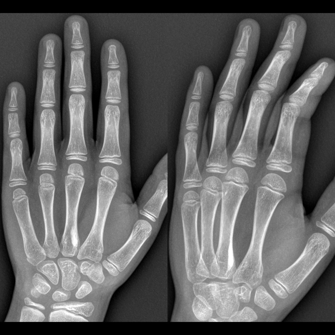 Pediatric Melorheostosis | Pediatric Radiology Reference Article ...