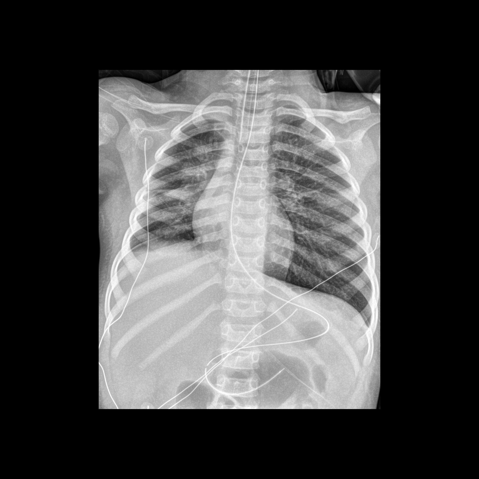 NasogastricTubeMalfunction16MDNasogastricTubeTipAtLigamentOfTreitzCXR2y ...