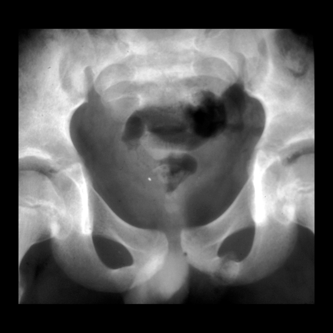 Pediatric Ischiopubic Synchondrosis Asymmetry | Pediatric Radiology ...