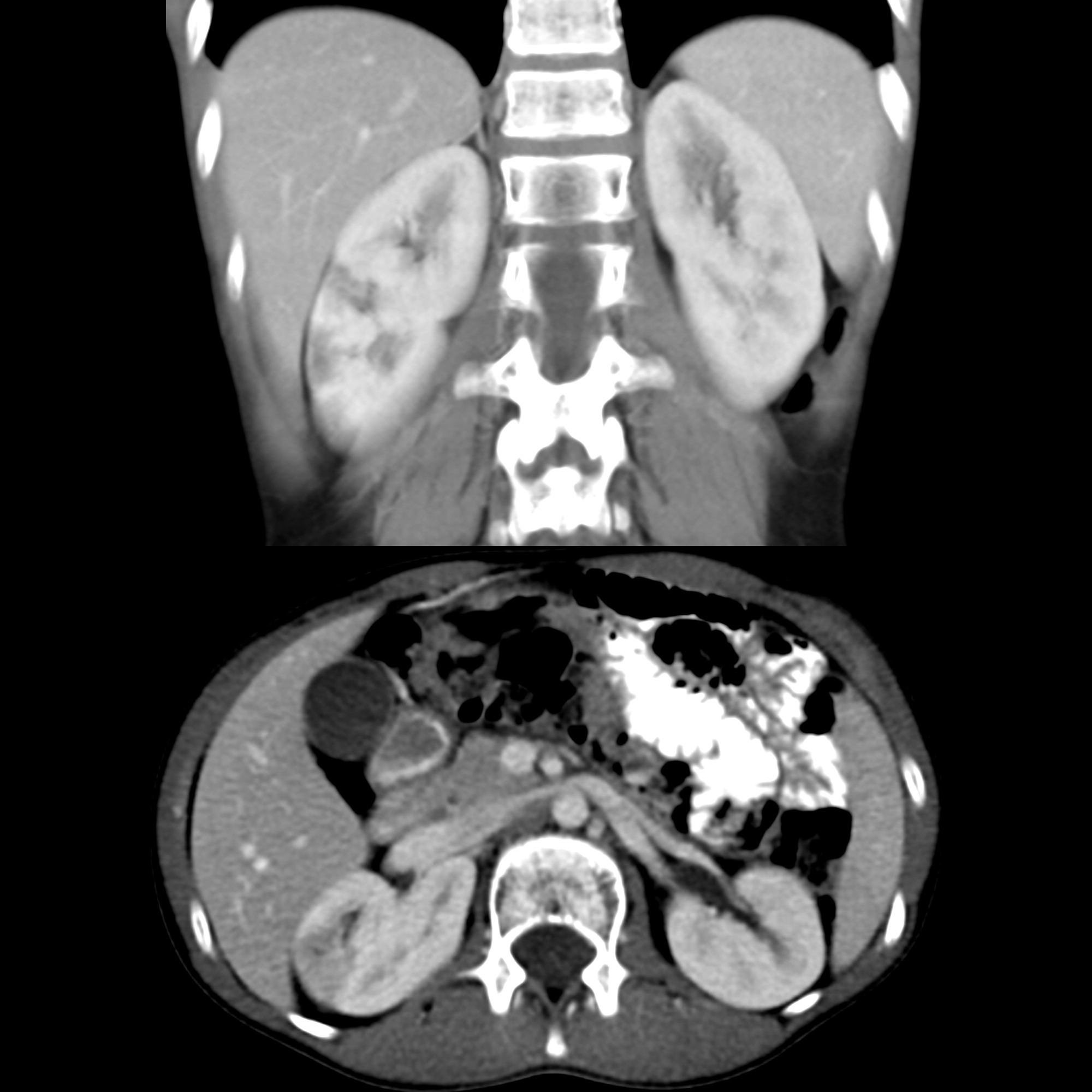 Pediatric Acute Pyelonephritis | Pediatric Radiology Reference Article ...