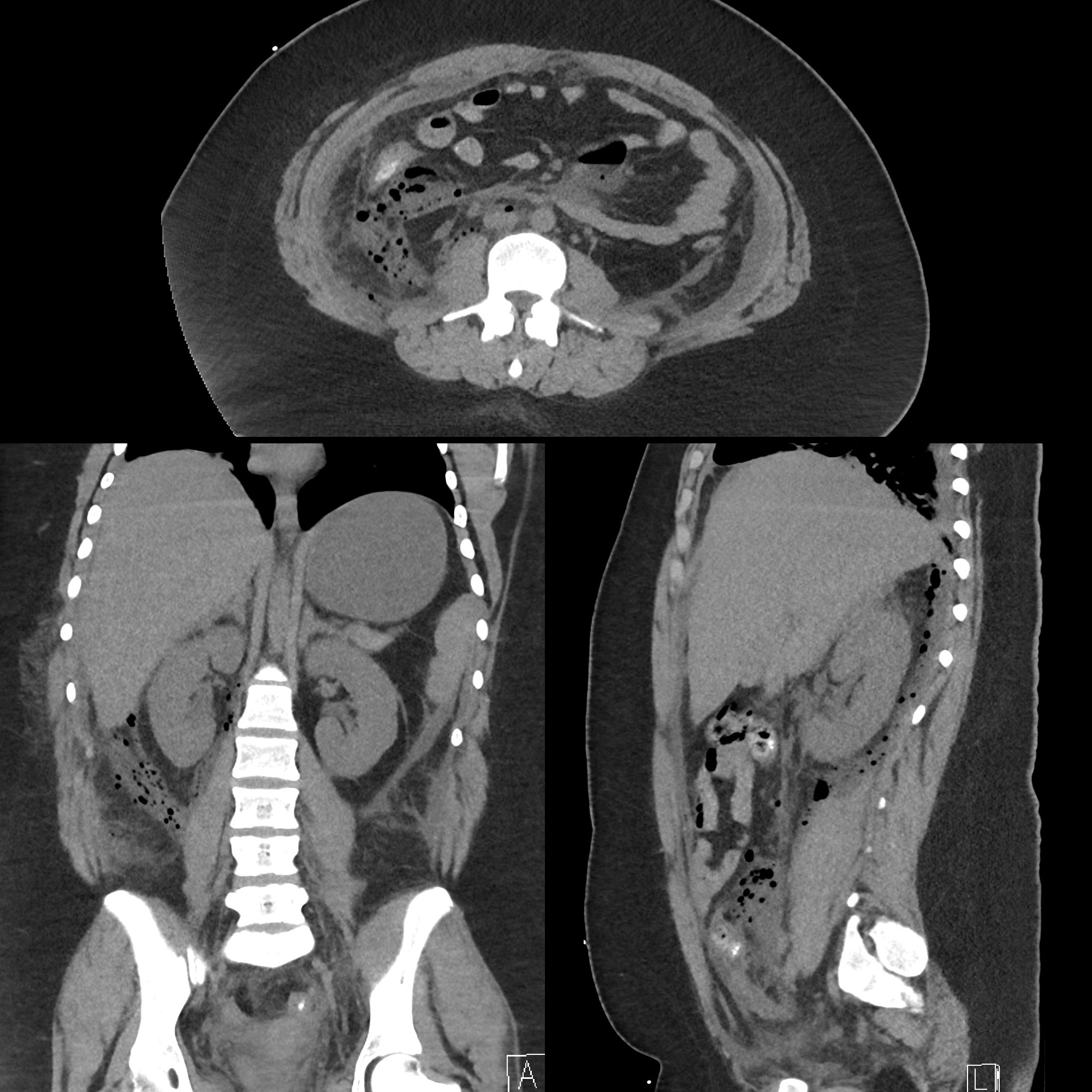Pediatric Appendicitis | Pediatric Radiology Reference Article ...