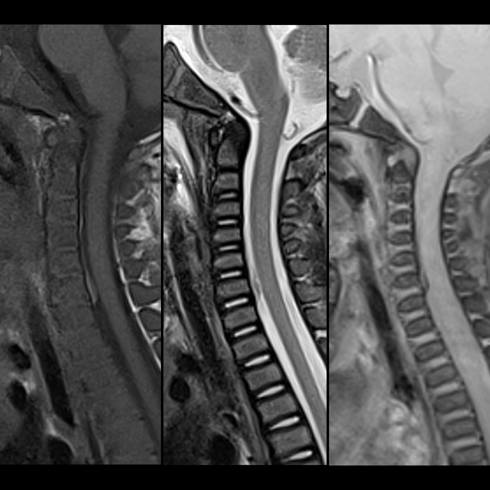 Pediatric Spinal Subdural Hematoma | Pediatric Radiology Reference ...