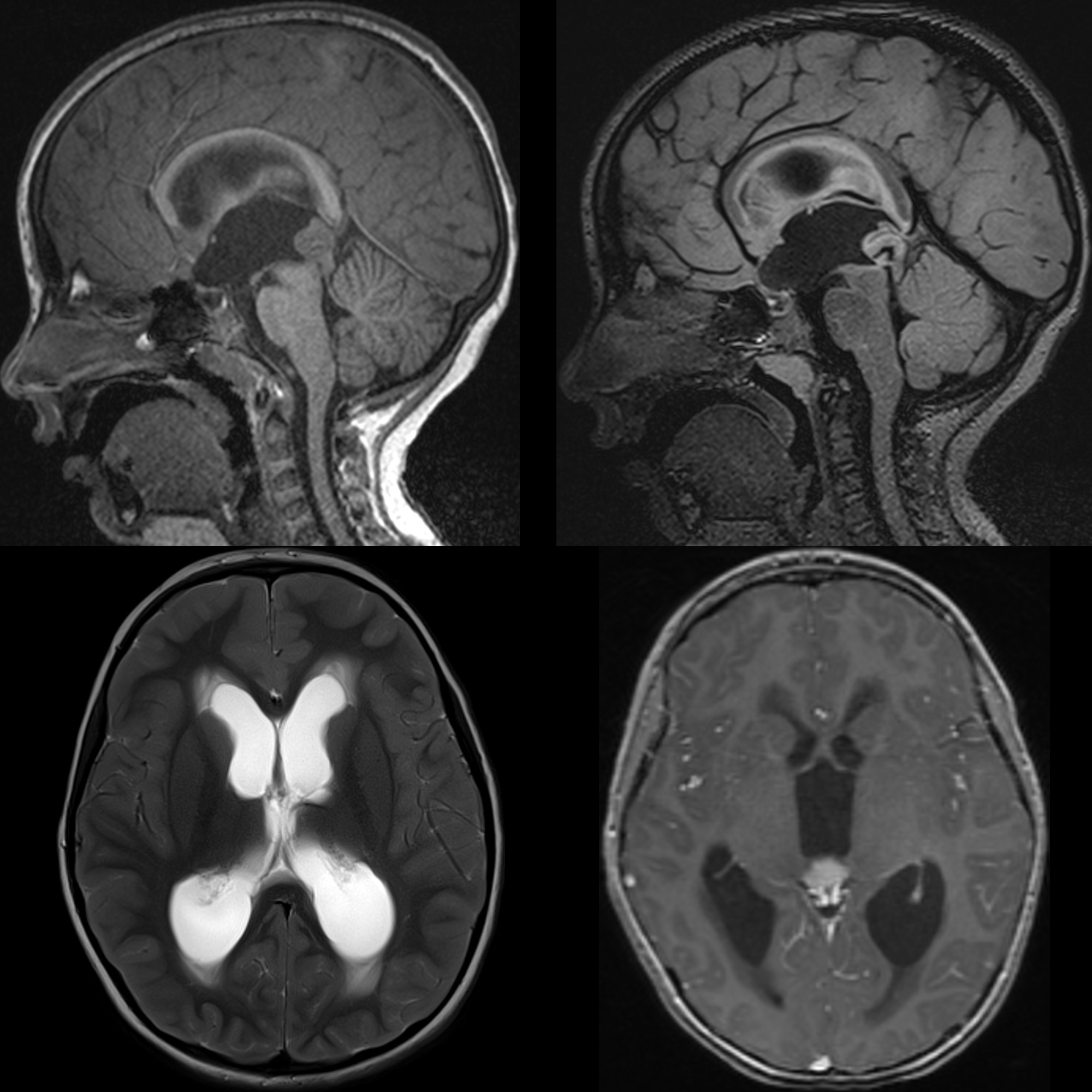 Pediatric Tectal Glioma | Pediatric Radiology Reference Article ...