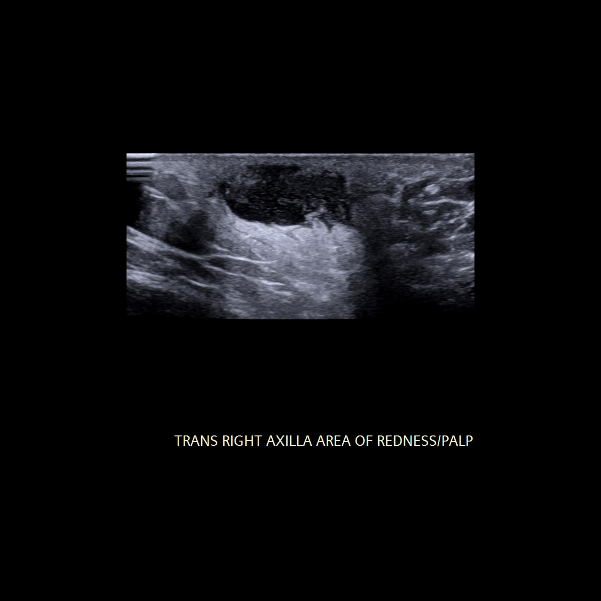 Pediatric Subcutaneous Abscess | Pediatric Radiology Reference Article ...