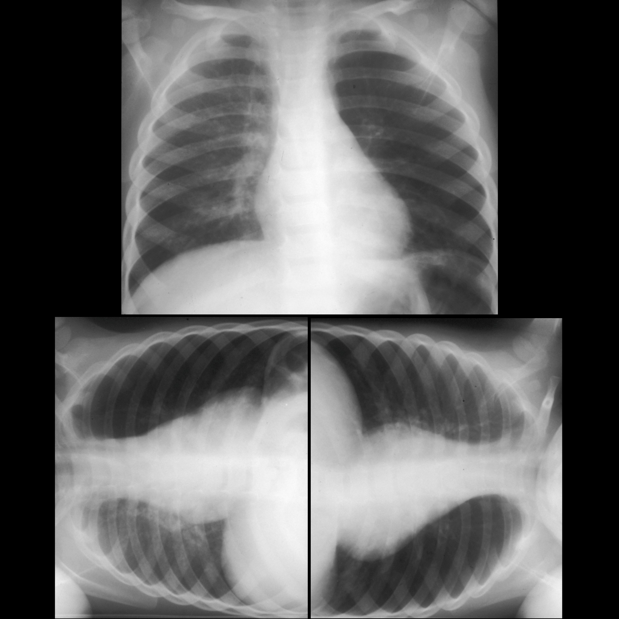 Pediatric Airway Foreign Body | Pediatric Radiology Reference Article ...