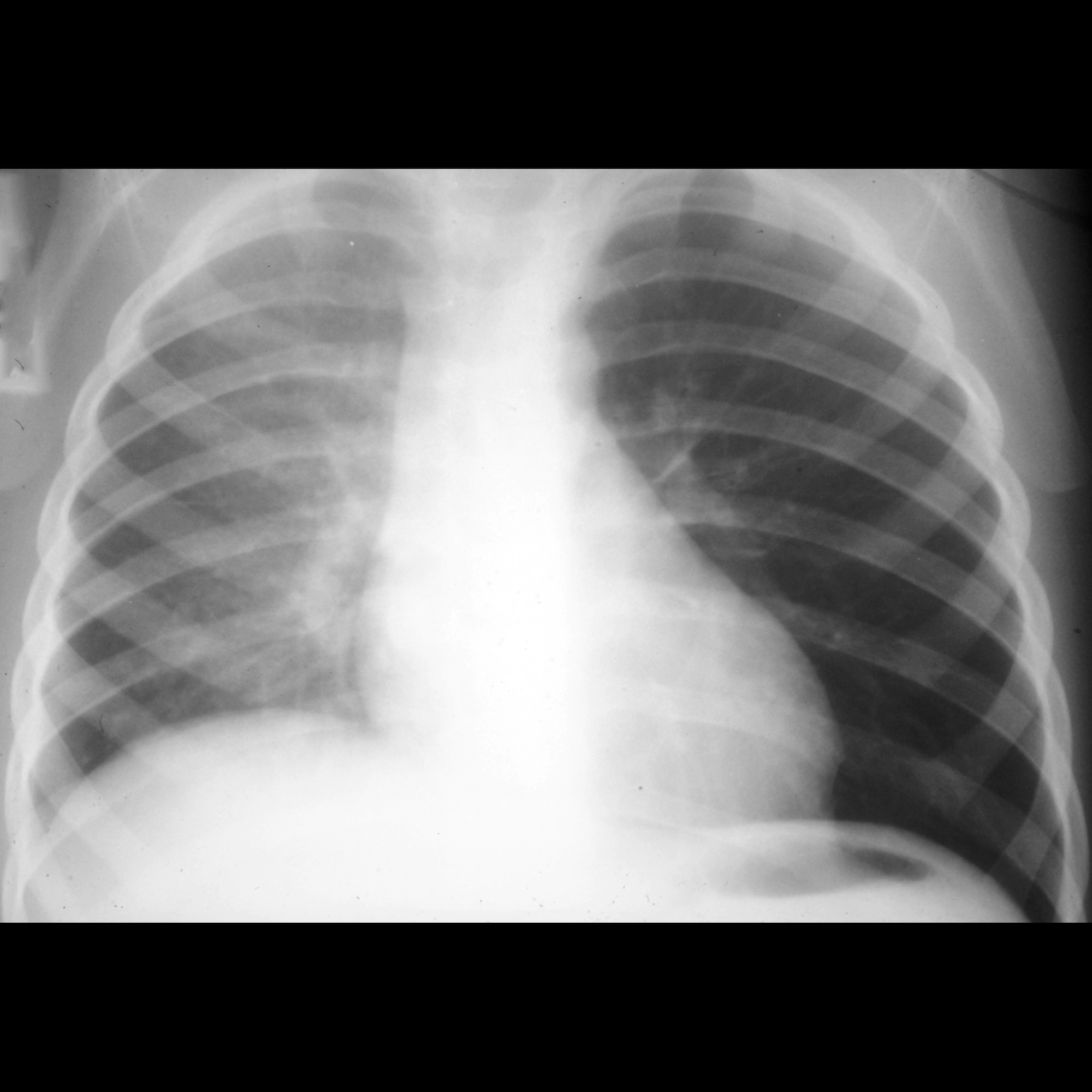 Pediatric Airway Foreign Body | Pediatric Radiology Reference Article ...