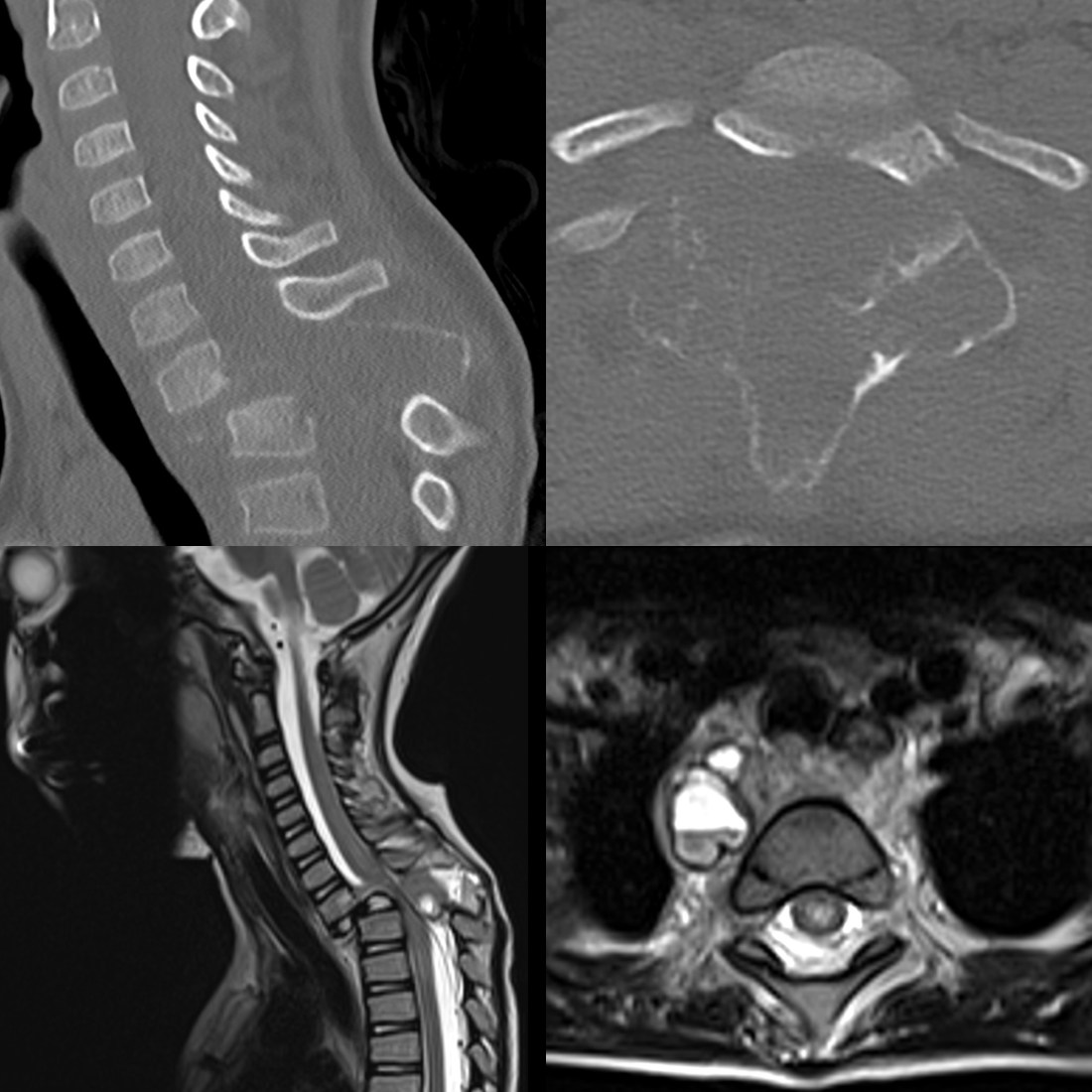 Pediatric Aneurysmal Bone Cyst | Pediatric Radiology Reference Article ...