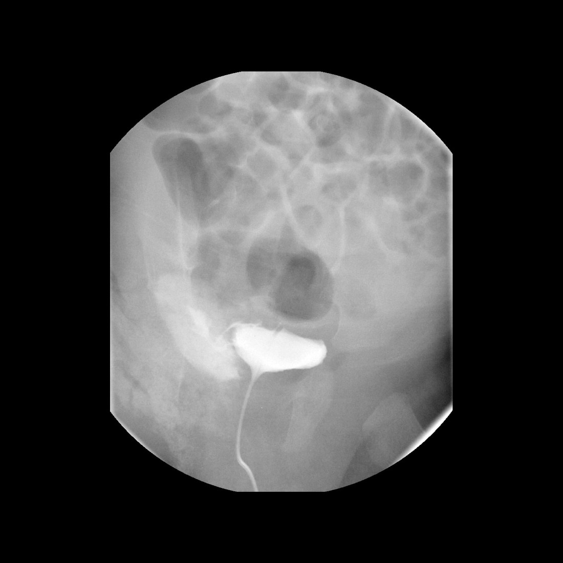 Pediatric Bladder Trauma | Pediatric Radiology Reference Article ...