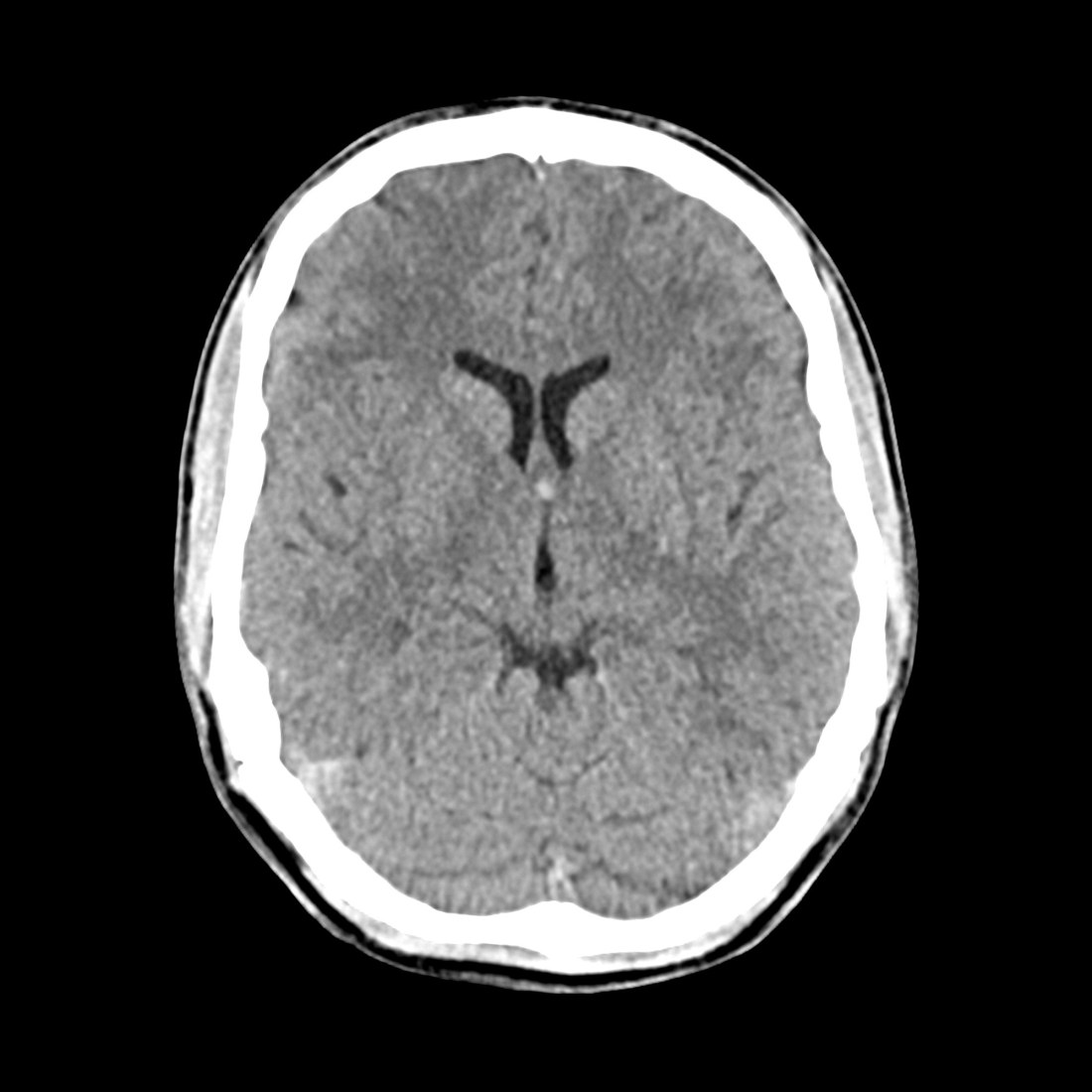 Pediatric Colloid Cyst Of Third Ventricle | Pediatric Radiology ...