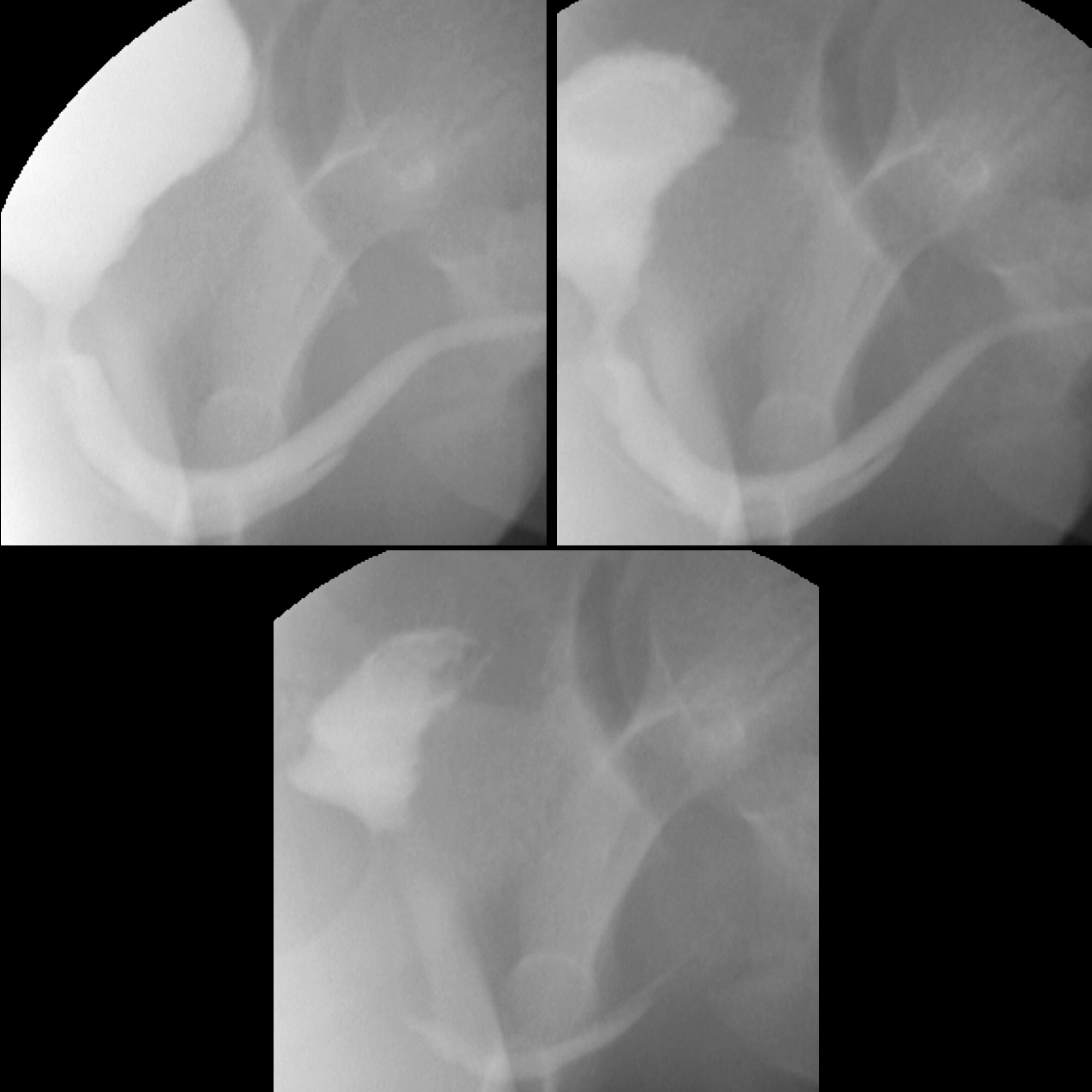 Pediatric Cowper Duct Syringocele | Pediatric Radiology Reference Article | Pediatric Imaging ...
