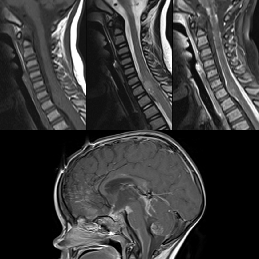 Pediatric Diffuse Leptomeningeal Glioneuronal Tumor | Pediatric ...