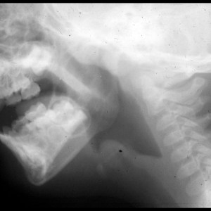 Epiglottitis | Pediatric Radiology Reference Article | Pediatric ...