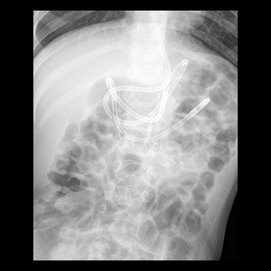 Pediatric Feeding Tube Malfunction / Malposition / Misposition ...
