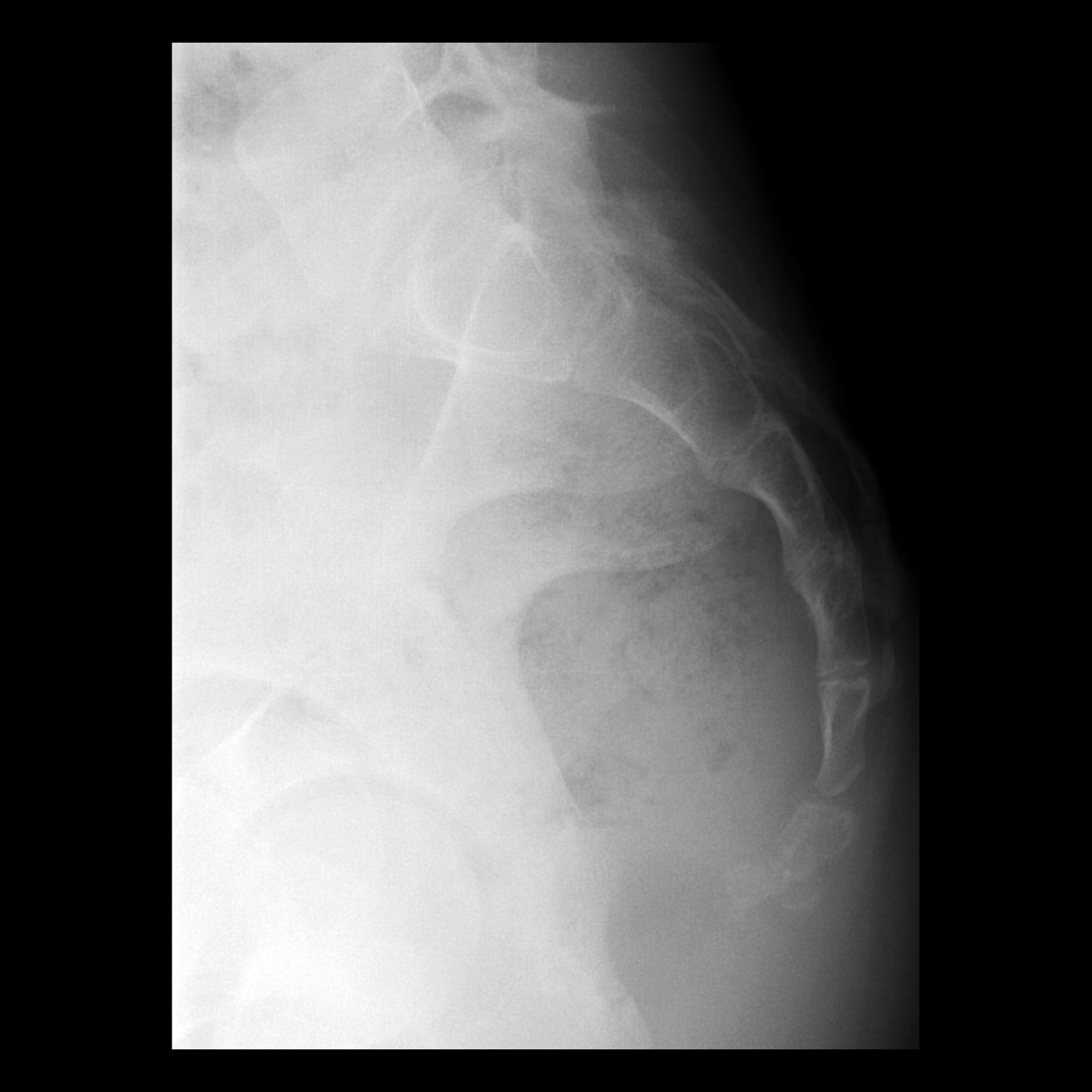 Pediatric Coccyx Fracture | Pediatric Radiology Reference Article ...