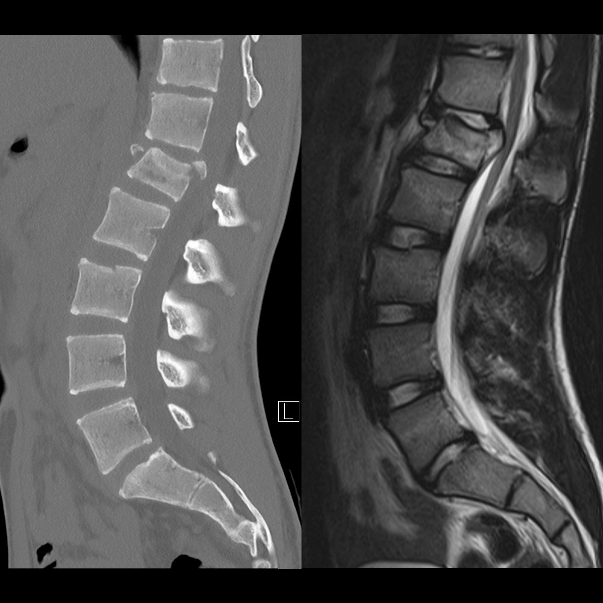 Pediatric Lumbar Spine Fracture | Pediatric Radiology Reference Article ...