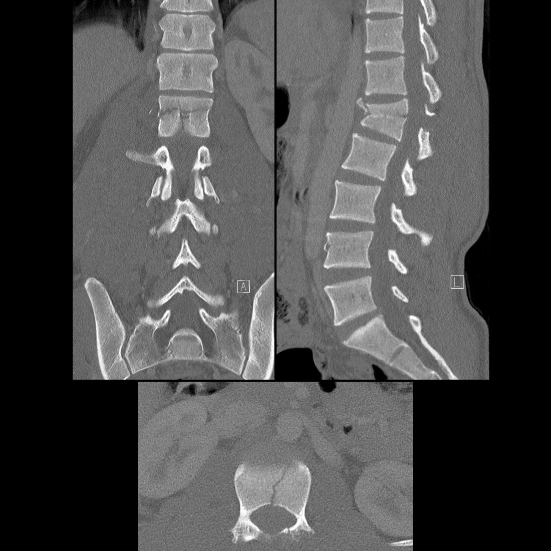 Pediatric Lumbar Spine Fracture | Pediatric Radiology Reference Article ...