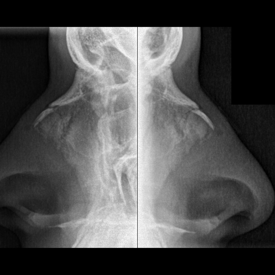 Pediatric Nasal Bone Fracture | Pediatric Radiology Reference Article ...