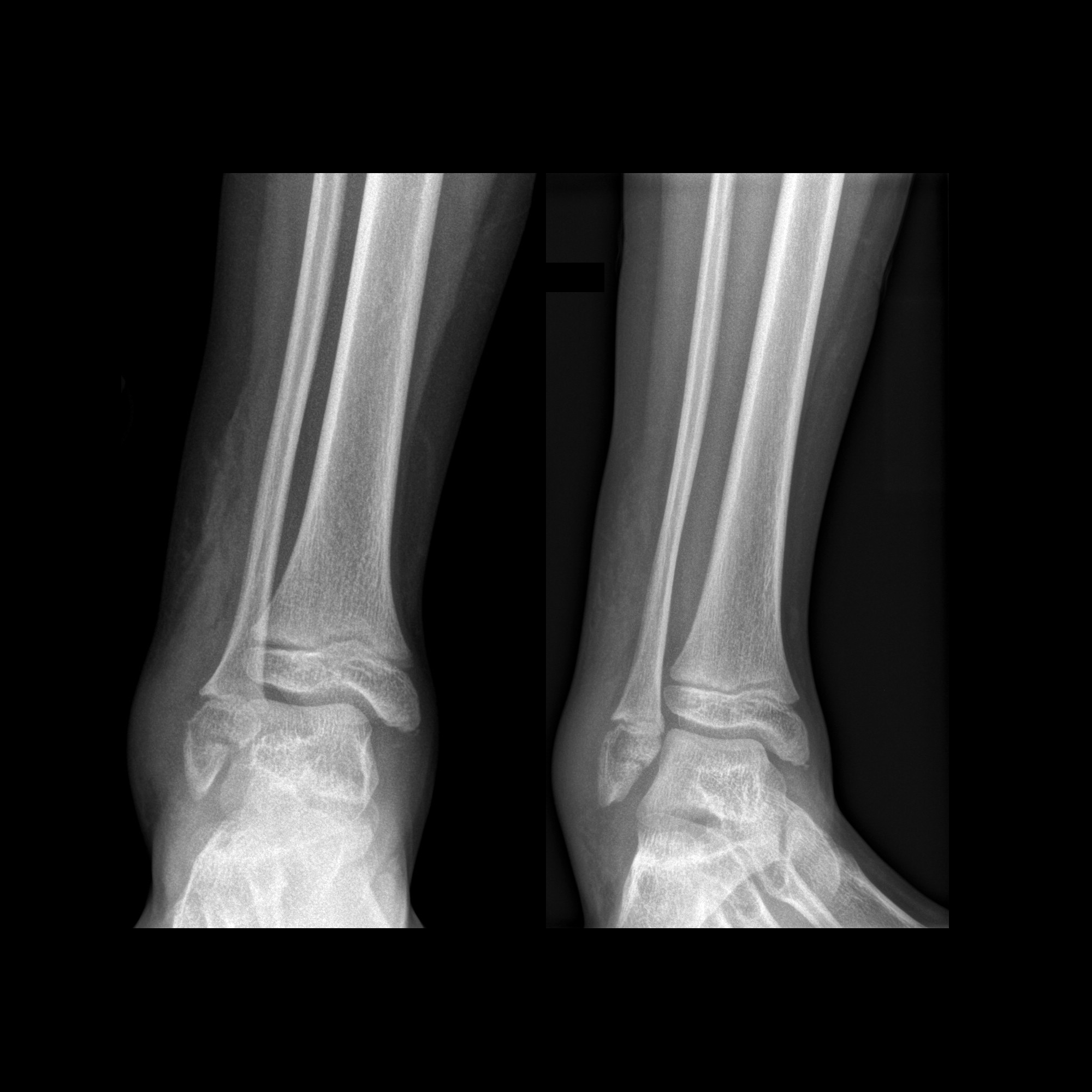Salter-Harris Fracture | Pediatric Radiology Reference Article ...