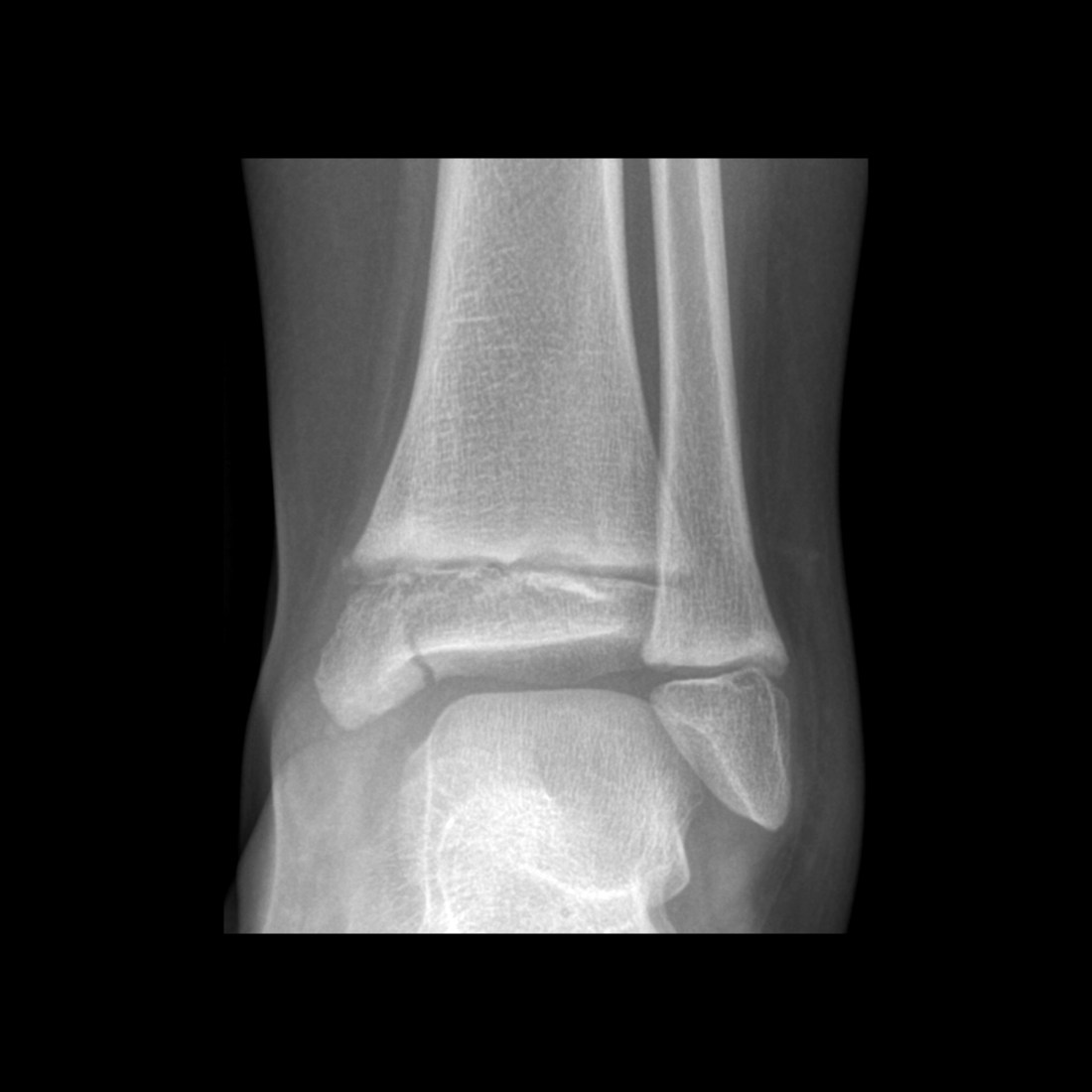 Salter-Harris Fracture | Pediatric Radiology Reference Article ...