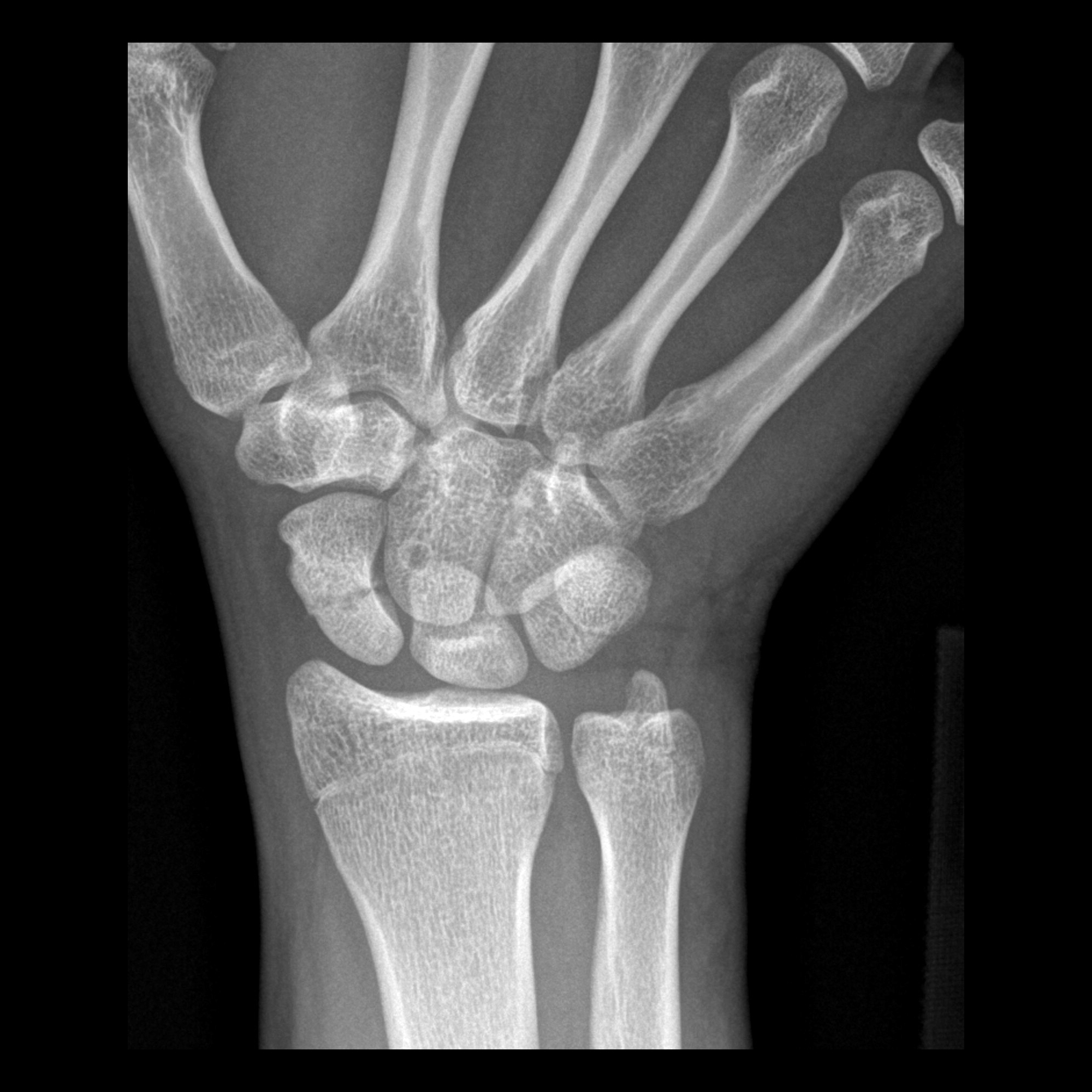 Pediatric Scaphoid Fracture | Pediatric Radiology Reference Article ...