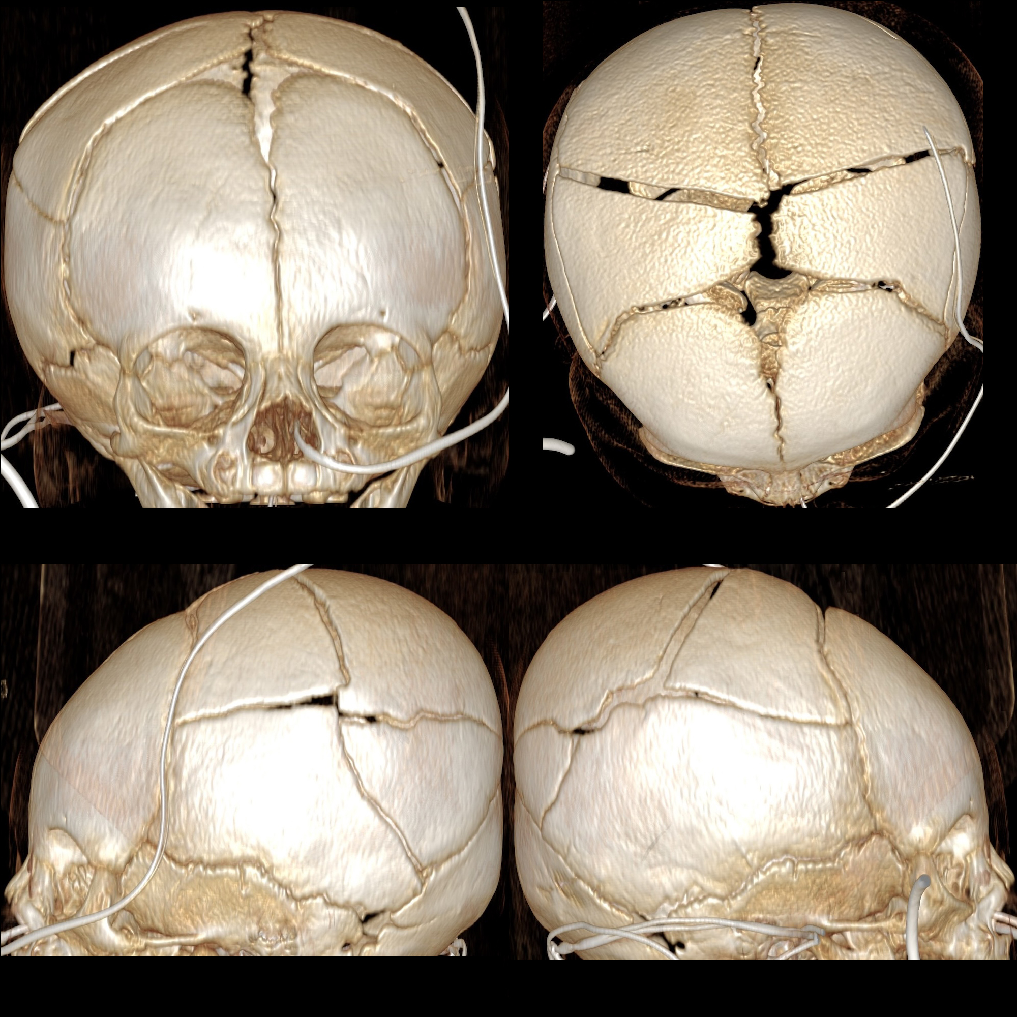 Pediatric Skull Fracture | Pediatric Radiology Reference Article ...