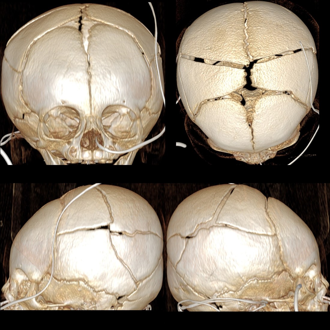 Pediatric Skull Fracture | Pediatric Radiology Reference Article ...