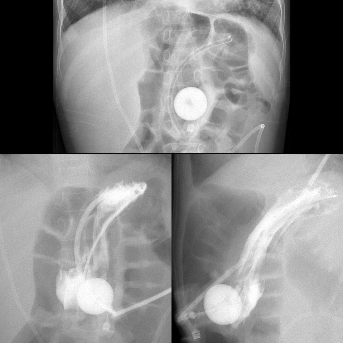 Pediatric Gastrojejunostomy Tube Malfunction / Malposition ...