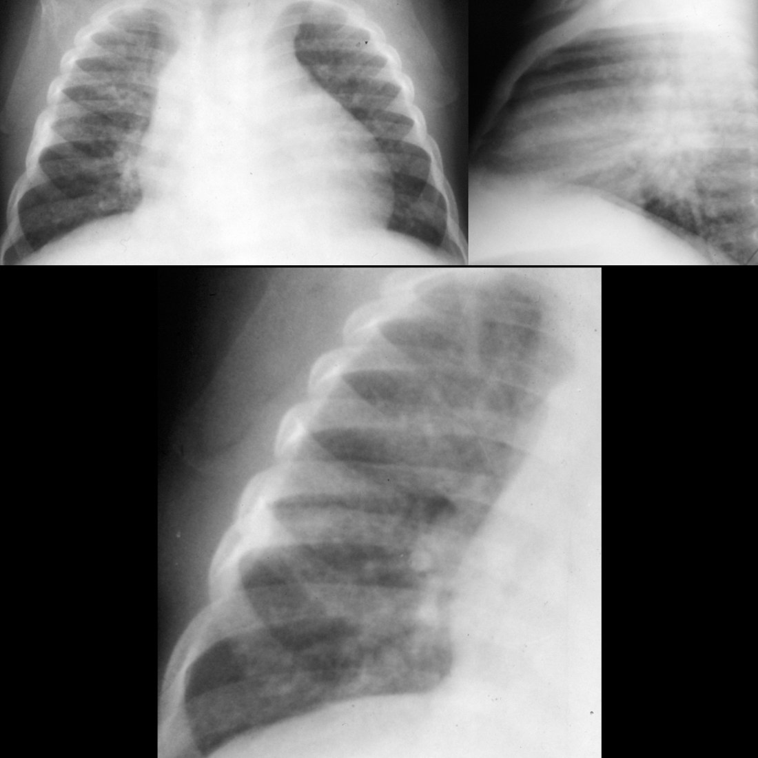 Pediatric Lymphoid Interstitial Pneumonia | Pediatric Radiology ...