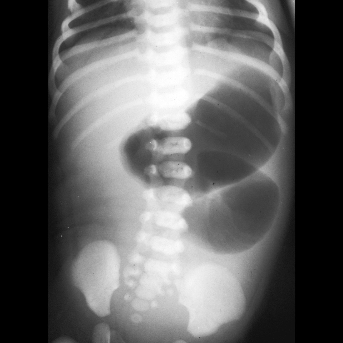 Jejunal Atresia | Pediatric Radiology Reference Article | Pediatric ...