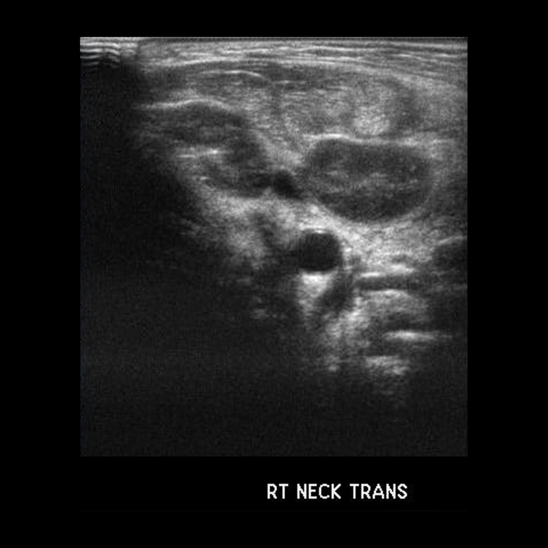 Pediatric Lymphadenopathy | Pediatric Radiology Reference Article ...