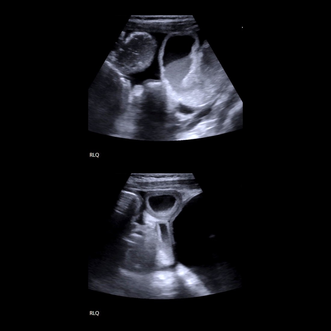 Pediatric Small Bowel Ischemia | Pediatric Radiology Reference Article ...