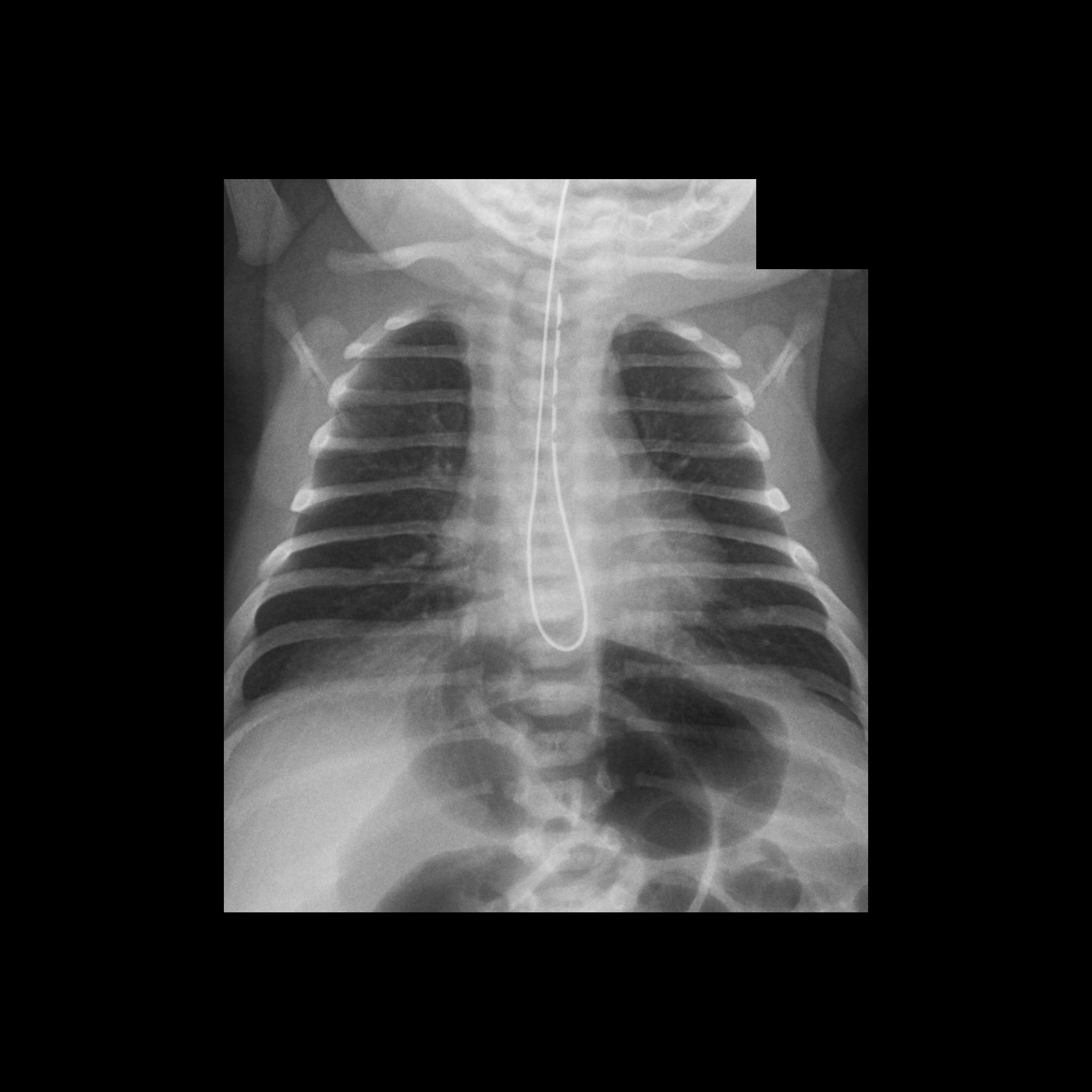 Pediatric Nasogastric Tube Malfunction / Malposition / Misposition ...