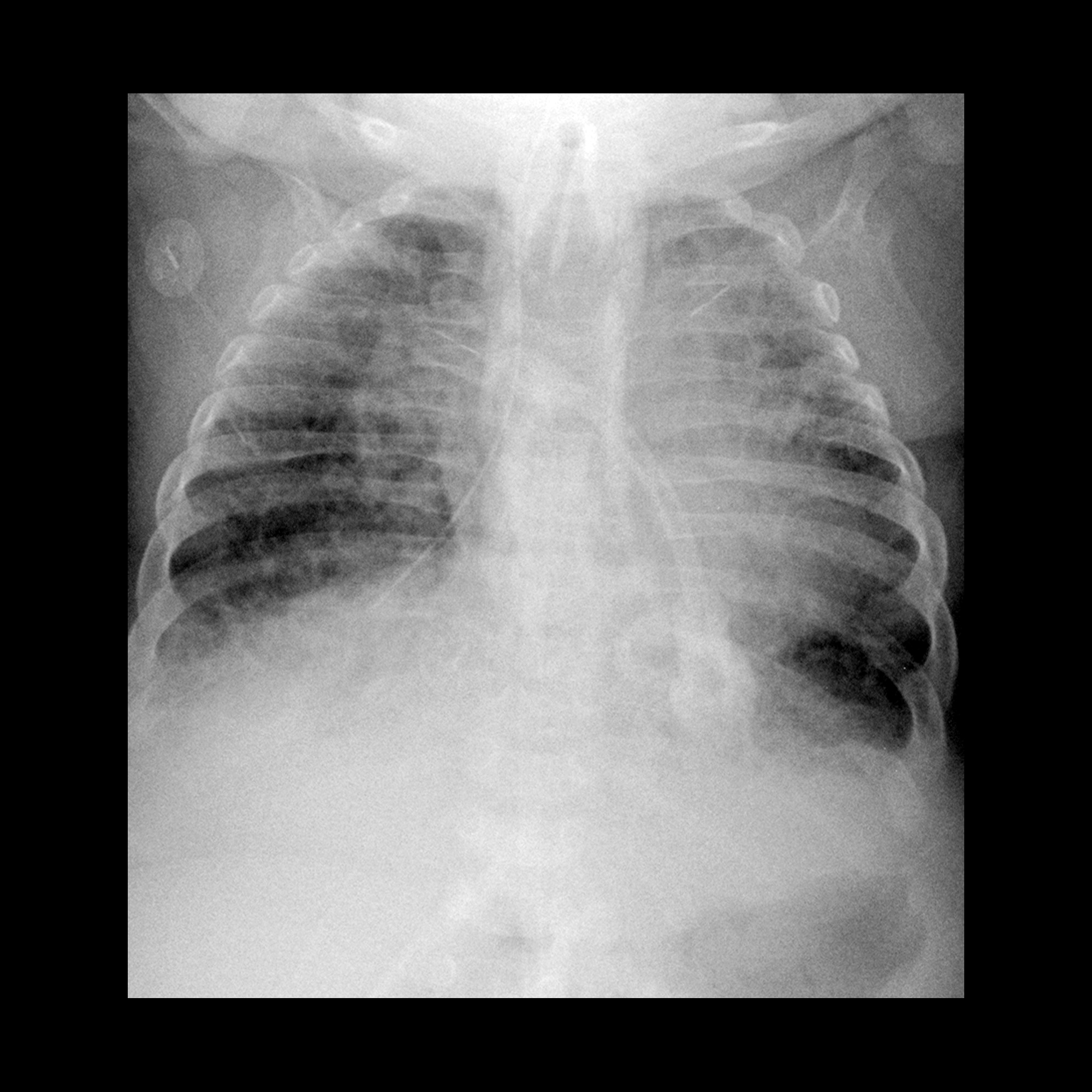 Pediatric Nasogastric Tube Malfunction / Malposition / Misposition ...