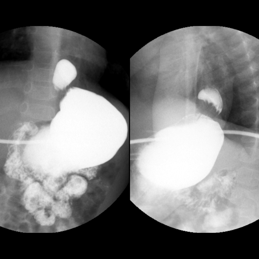 Pediatric Nissen Fundoplication Malfunction | Pediatric Radiology ...