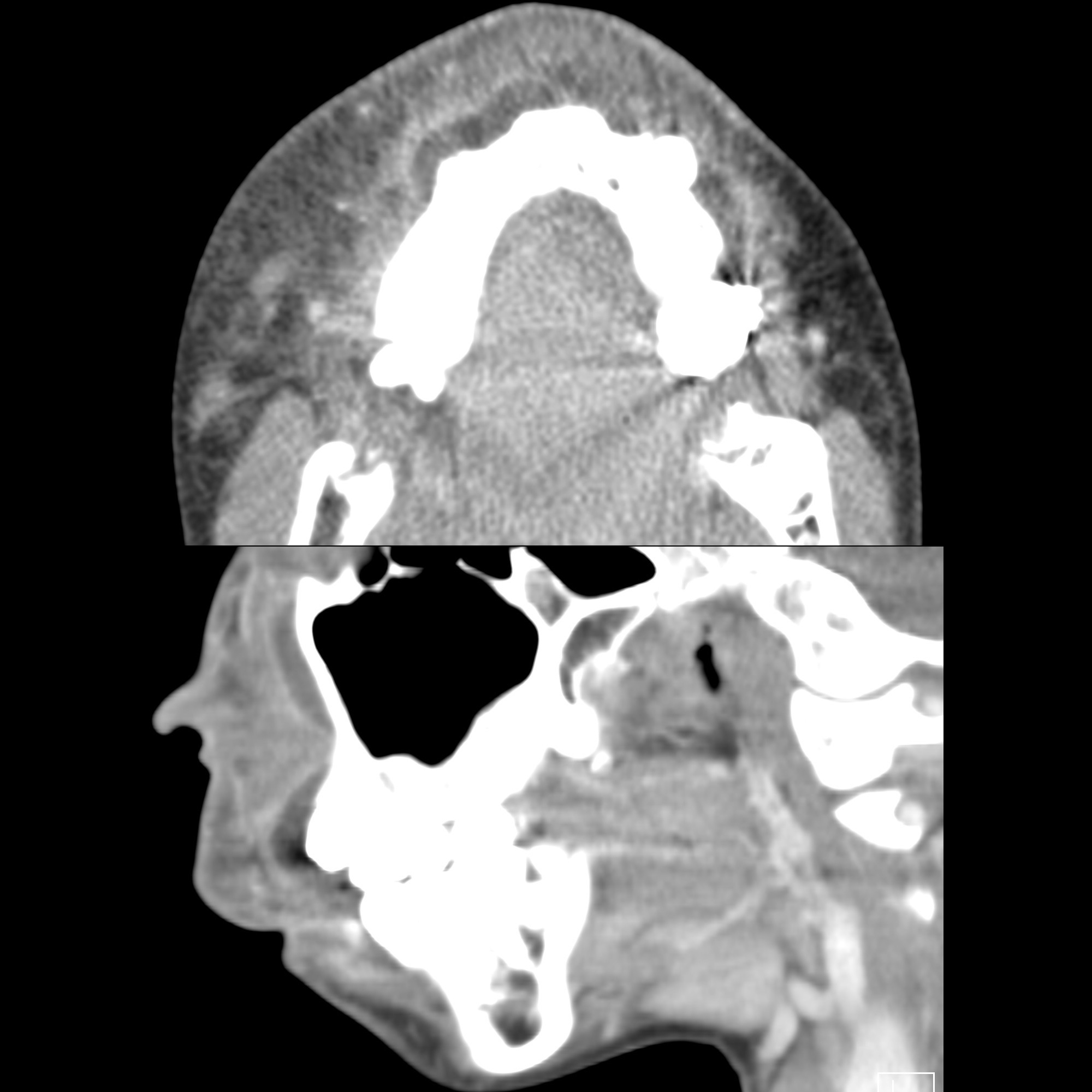 Pediatric Periapical Abscess | Pediatric Radiology Reference Article ...