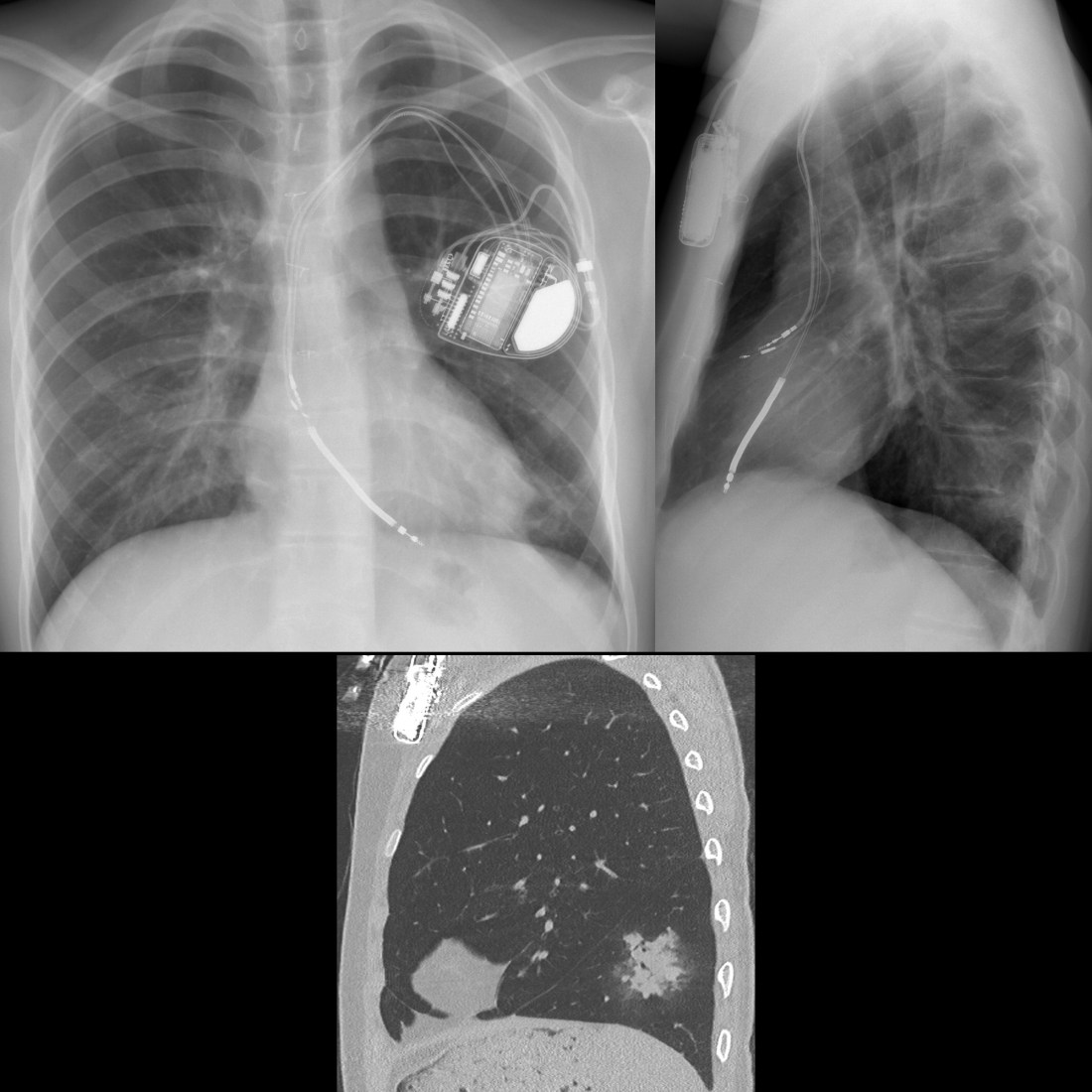 Pediatric Bacterial Pneumonia | Pediatric Radiology Reference Article ...