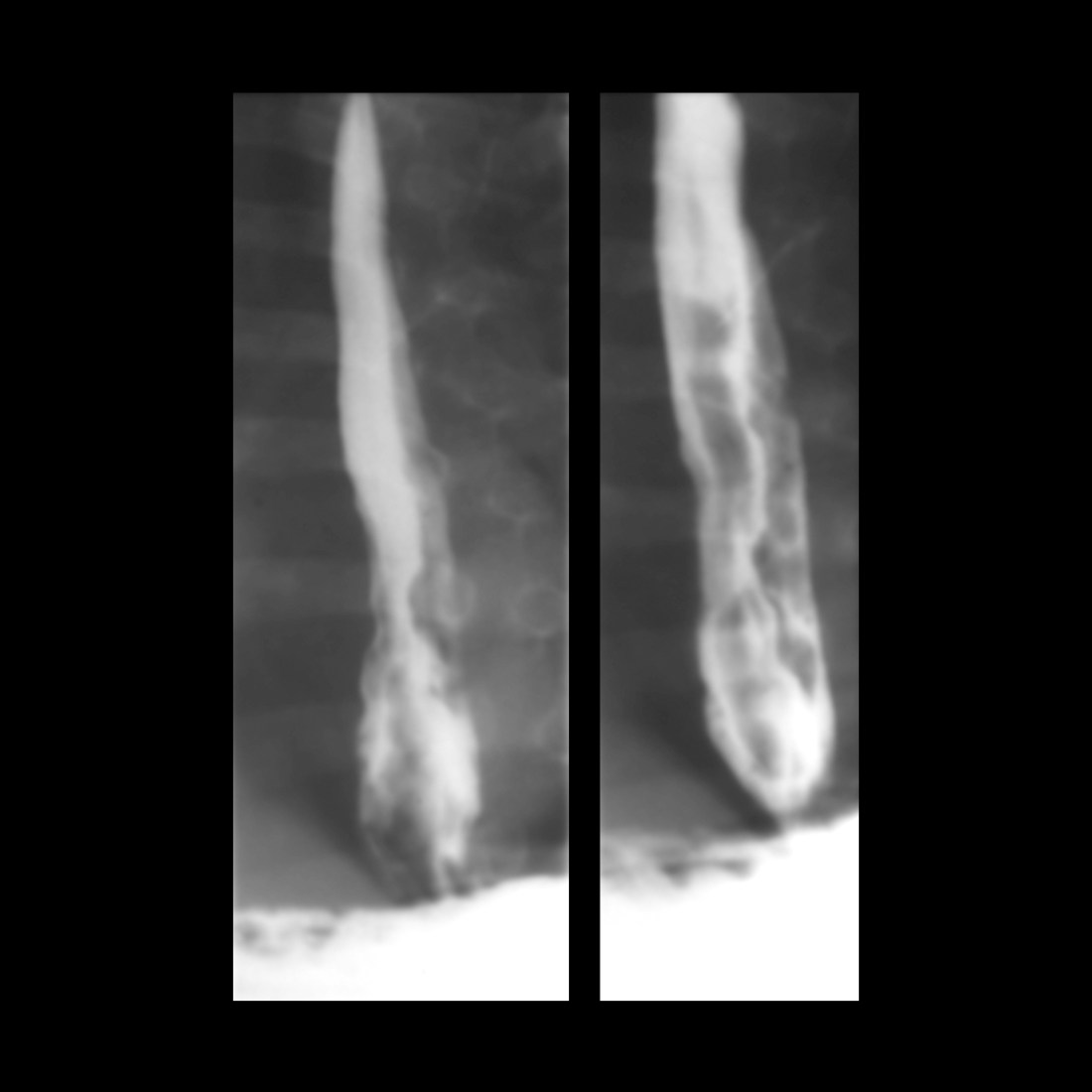 Pediatric Portal Hypertension | Pediatric Radiology Reference Article ...