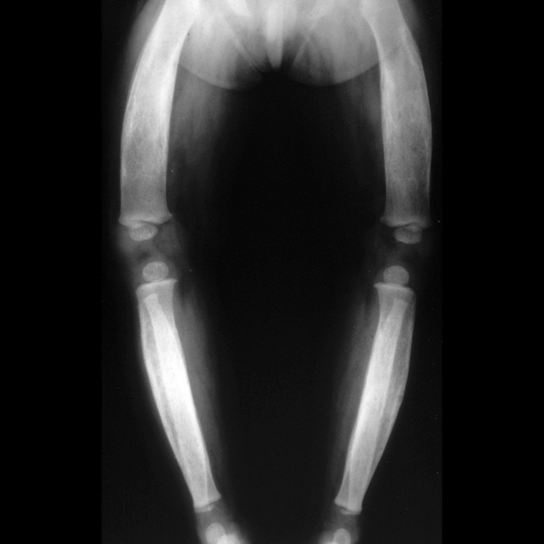 Pediatric Syphilis | Pediatric Radiology Reference Article | Pediatric ...